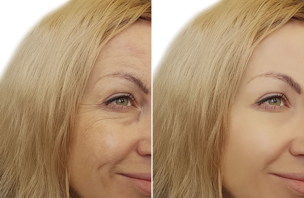 Anti Wrinkle Injections Gold Coast | Wrinkle Reduction Treatment